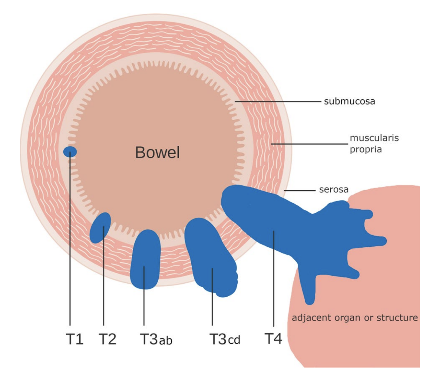 Episode 099: Colorectal Cancer Series, Pt. 1 - Intro to Colorectal Cancer — The Fellow On Call